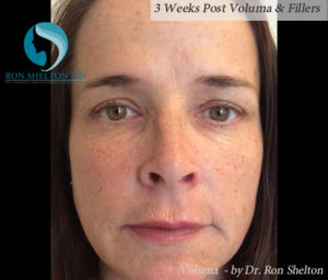 Voluma Fillers NYC | Anti Aging Treatments NYC by Dr Ron Shelton