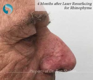 Laser Resurfacing for Rhinophyma NYC Before and After Photos