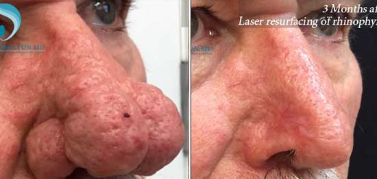 Rhinophyma RF Resurfacing | Rhinophyma Treatment With Lasers