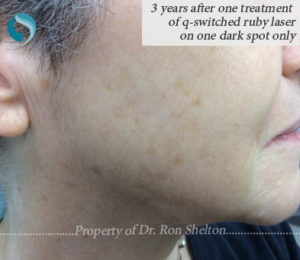 Laser Peel treatment, removal of brown spots, age spots | Ron Shelton MD