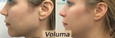 Voluma Fillers NYC | Anti Aging Treatments NYC by Dr Ron Shelton