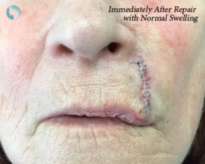 Mohs reconstruction New York | Before After photos of Mohs surgery