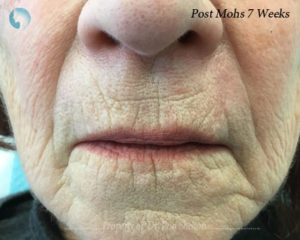 Mohs reconstruction New York | Before After photos of Mohs surgery