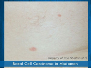 Skin Cancer New York | Basal Cell Carcinoma - Ron Shelton MD
