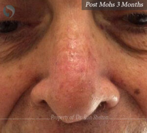 Mohs reconstruction New York | Before After photos of Mohs surgery