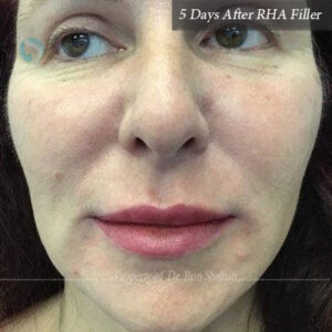 Resilient Hyaluronic Acid RHA® Before After Photos - Ron Shelton M.D.