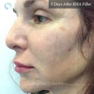 Resilient Hyaluronic Acid RHA® Before After Photos - Ron Shelton M.D.