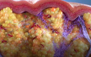 QWO: The First FDA Approved Injectable for Cellulite | Ron Shelton M.D.