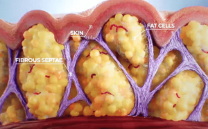 QWO: The First FDA Approved Injectable for Cellulite | Ron Shelton M.D.