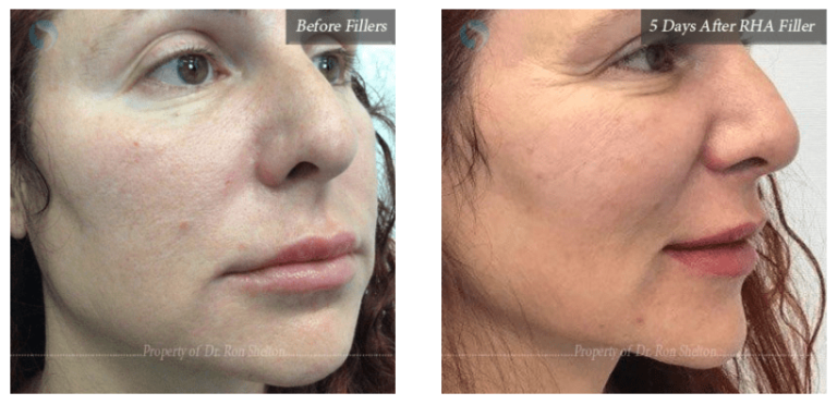 Non-Surgical MidFace Lift with Facial Fillers | Midface Filler NYC