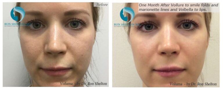 Non-Surgical MidFace Lift with Facial Fillers | Midface Filler NYC