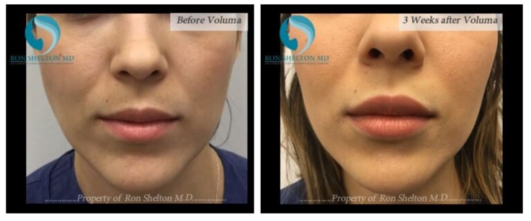 Non-Surgical MidFace Lift with Facial Fillers | Midface Filler NYC