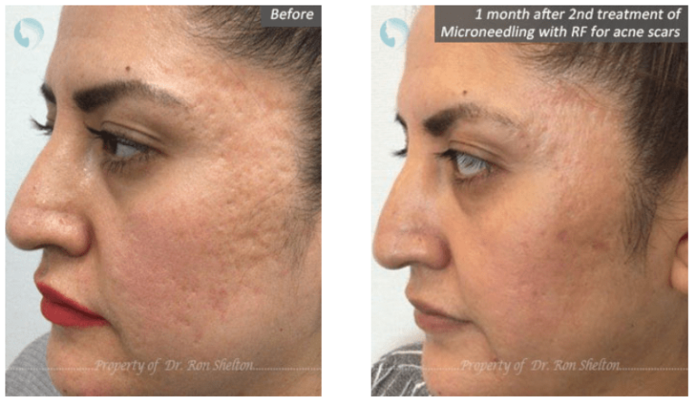 Does RF Microneedling work on acne scars? | Acne Scars Reduction NYC