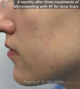 Microneedling with RF Before and After photos | Ron Shelton MD