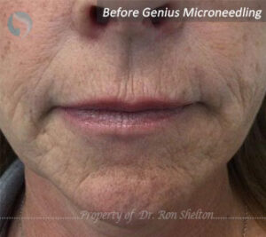 Microneedling with RF Before and After photos | Ron Shelton MD