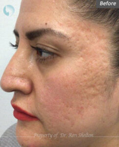 Microneedling with RF Before and After photos | Ron Shelton MD