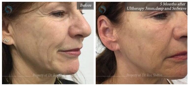 Sofwave skin tightening New York City | Ron Shelton M.D. New York City