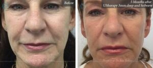 Sofwave skin tightening NYC wrinkle treatment near me | Ron Shelton MD