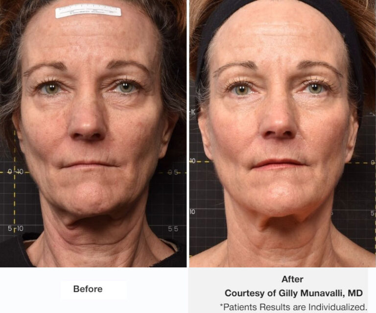Sofwave non-surgical facial lifting in NYC | Nonsurgical face lift NYC, NY