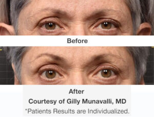 Sofwave NYC Nonsurgical BrowLift | Non Surgical Wrinkle Treatment NYC