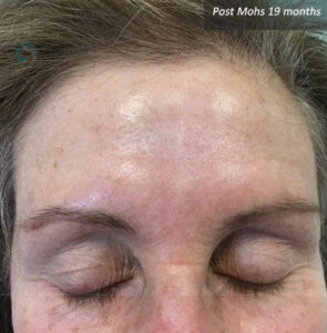 Forehead Mohs and Reconstruction Surgeries Before and After Pictures