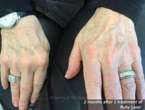 Brown Spots | Dark Spots Laser Removal Before & After - Ron Shelton MD