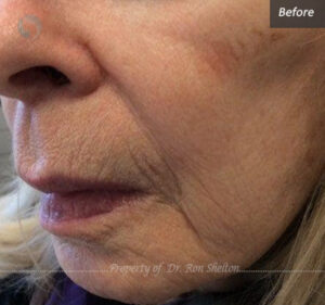 Microneedling with RF Before and After photos | Ron Shelton MD