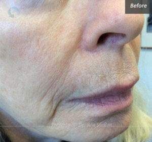 Microneedling with RF Before and After photos | Ron Shelton MD