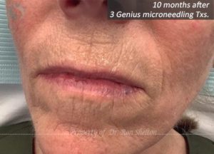 Microneedling with RF Before and After photos | Ron Shelton MD