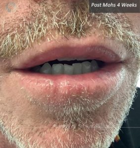 Mohs reconstruction New York | Before After photos of Mohs surgery