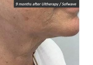Sofwave skin tightening Before After NYC | Sofwave Ultherapy NY