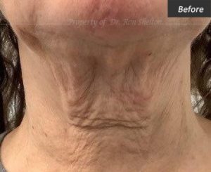 Sofwave skin tightening Before After NYC | Sofwave Ultherapy NY