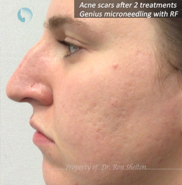 Microneedling with RF Before and After photos | Ron Shelton MD