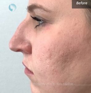 Microneedling with RF Before and After photos | Ron Shelton MD