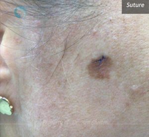 Brown Spots | Dark Spots Laser Removal Before & After - Ron Shelton MD