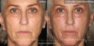 Laser skin resurfacing before and after photo gallery New York City