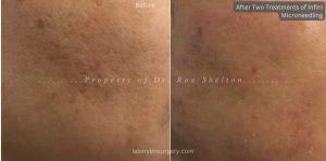 Microneedling with RF Before and After photos | Ron Shelton MD