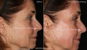 Laser skin resurfacing before and after photo gallery New York City