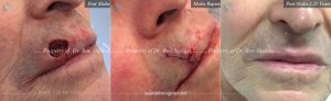 Mohs reconstruction New York | Before After photos Mohs surgery