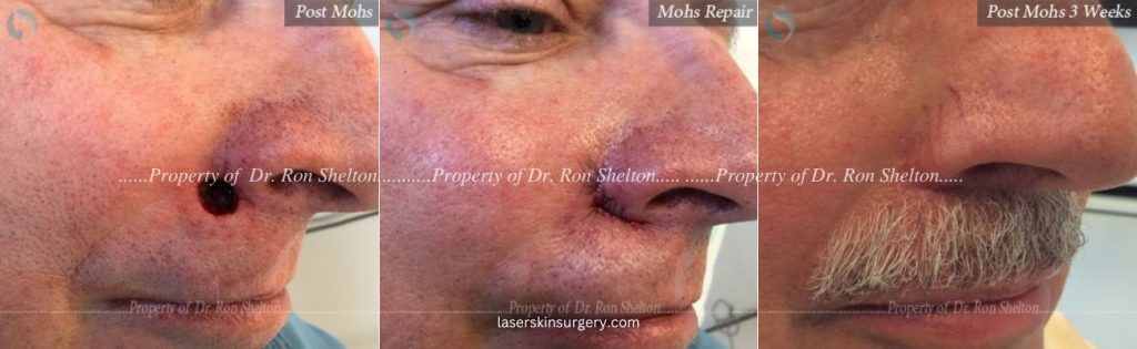 Mohs reconstruction New York | Before After photos Mohs surgery