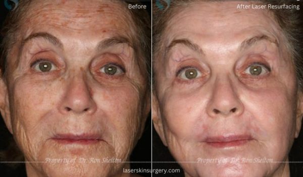 Laser skin resurfacing before and after photo gallery New York City