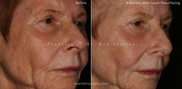 Laser skin resurfacing before and after photo gallery New York City