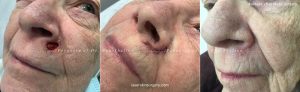 Mohs reconstruction New York | Before After photos Mohs surgery