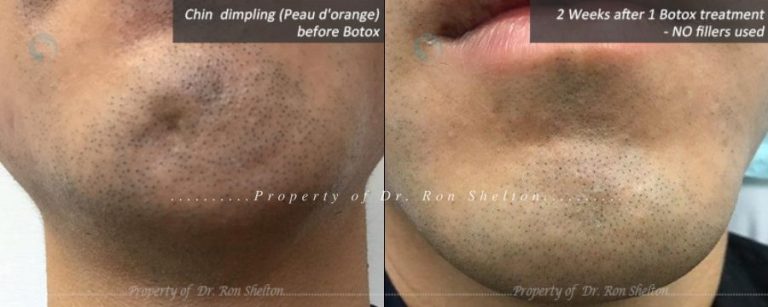 Dysport Botox Daxxify New York City before after | Ron Shelton MD