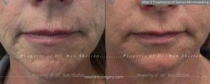 Microneedling with RF Before and After photos | Ron Shelton MD
