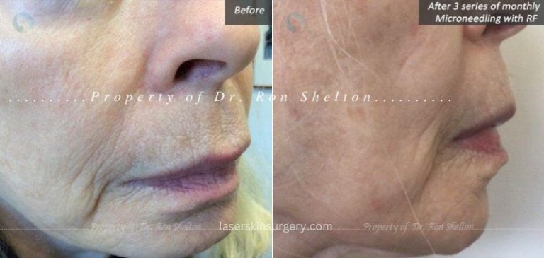 Microneedling with RF Before and After photos | Ron Shelton MD
