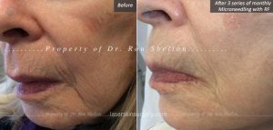 Microneedling with RF Before and After photos | Ron Shelton MD