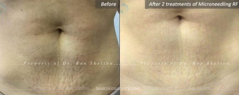 Microneedling with RF Before and After photos | Ron Shelton MD
