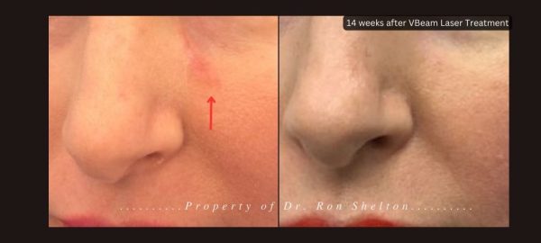Vbeam Laser NYC | Before and After Vbeam - Ron Shelton MD