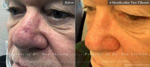 Vbeam Laser NYC | Before and After Vbeam - Ron Shelton MD